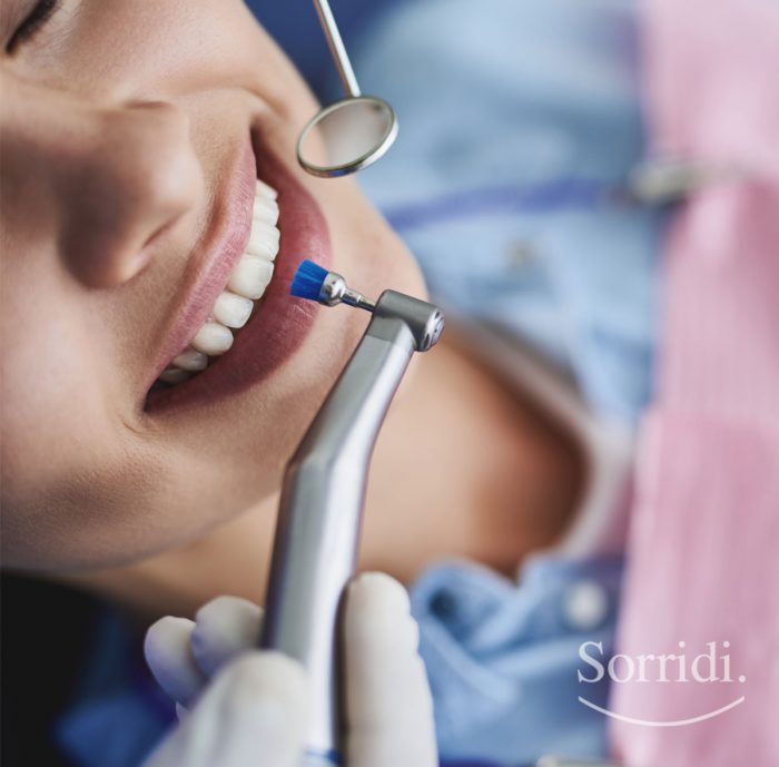 Pulizia professionale dei denti: quando e perché richiederla? - Sorridi ...